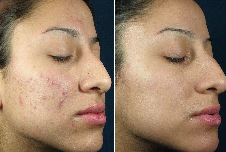 Chemical Peel Microdermabrasion Fairfax VA Impressions MedSpa
