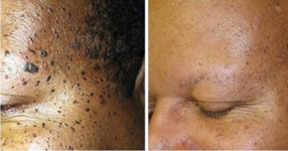 Skin Treatment: Acne, Fibromas, Skin Tags & more| Fairfax VA
